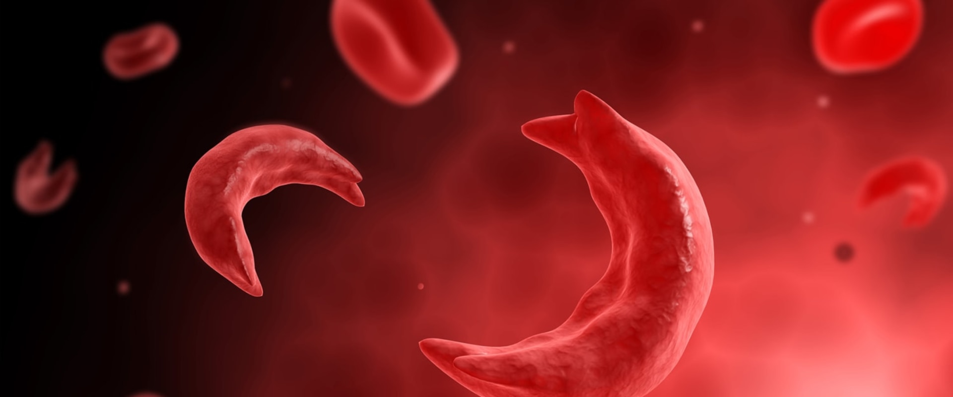 Why Does Sickle Cell Anemia Only Affect African American People? The ...